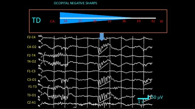Normal Neonatal EEG