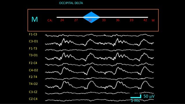 Normal Neonatal EEG