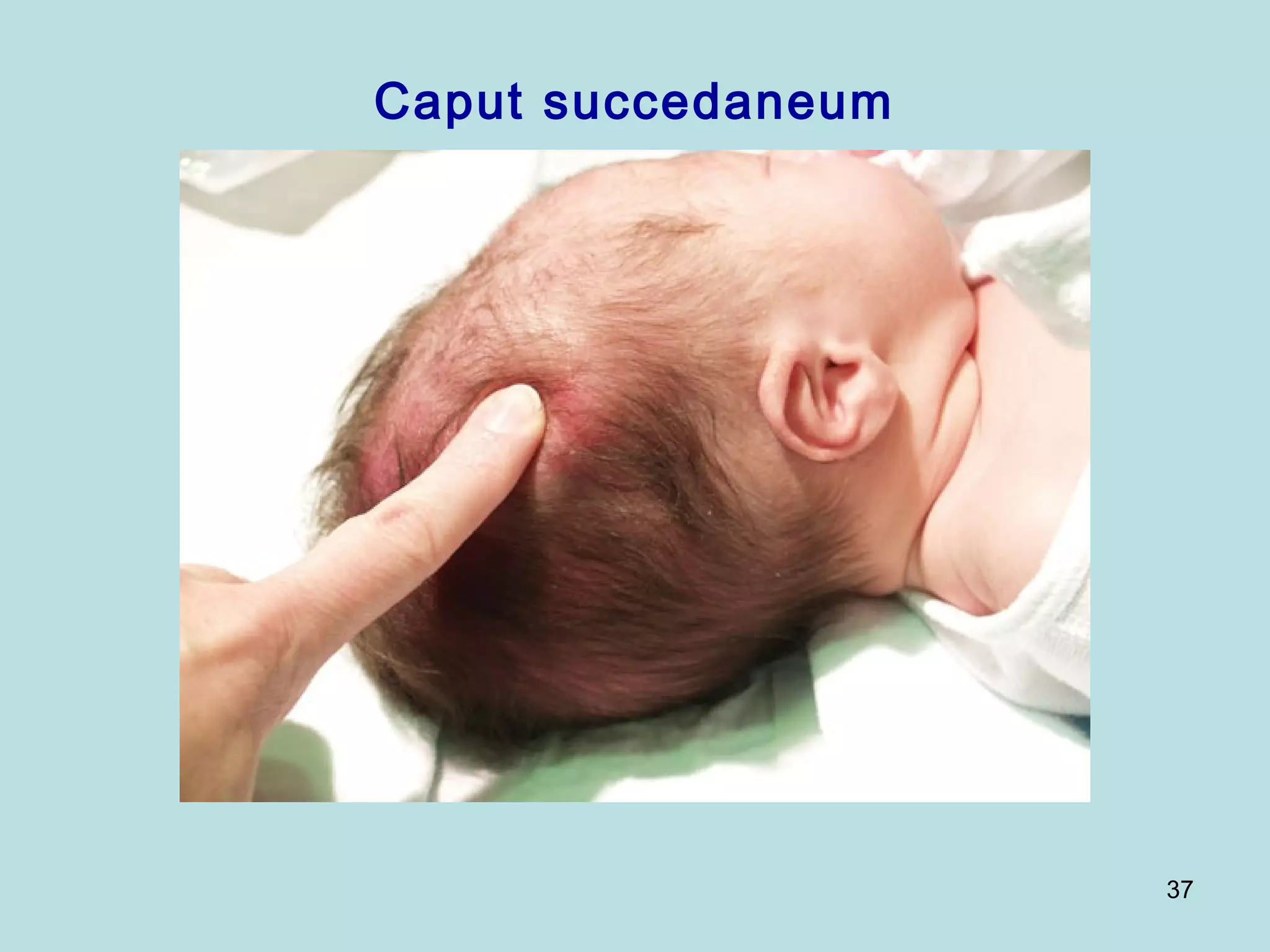 Normal newborn | PPT