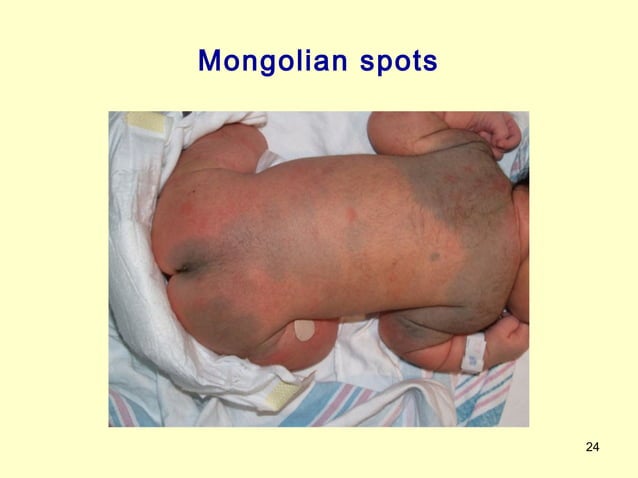 Normal newborn | PPT