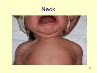 Normal newborn | PPT