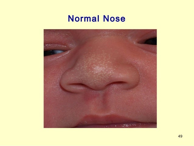 Normal newborn