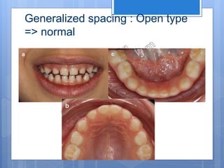 Development of normal dental occlusion in children.pptx | Free Download