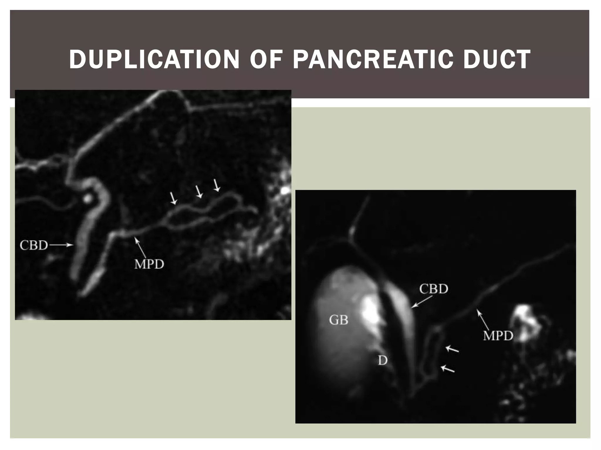 Normal pancreatic anatomy and anatomical variations | PPT