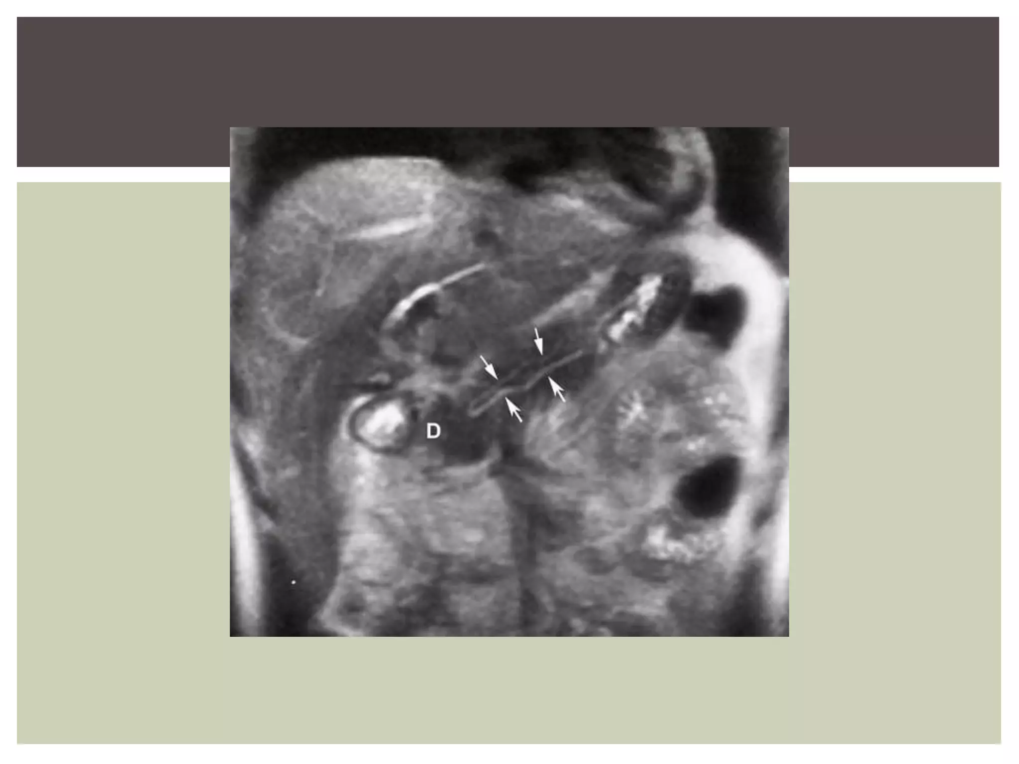 Normal pancreatic anatomy and anatomical variations | PPT