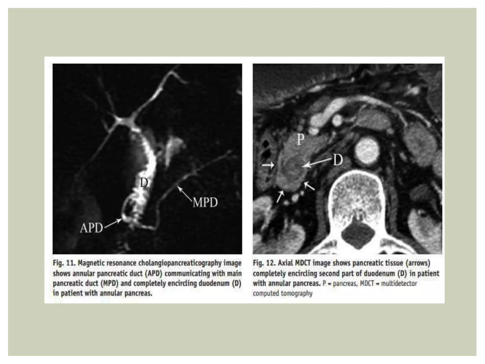 Normal pancreatic anatomy and anatomical variations | PPT