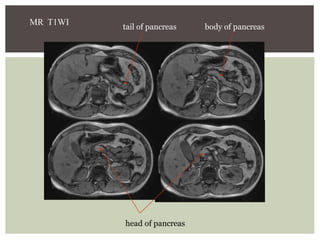 Normal pancreatic anatomy and anatomical variations | PPTX