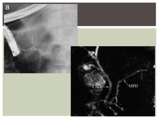 Normal pancreatic anatomy and anatomical variations | PPTX