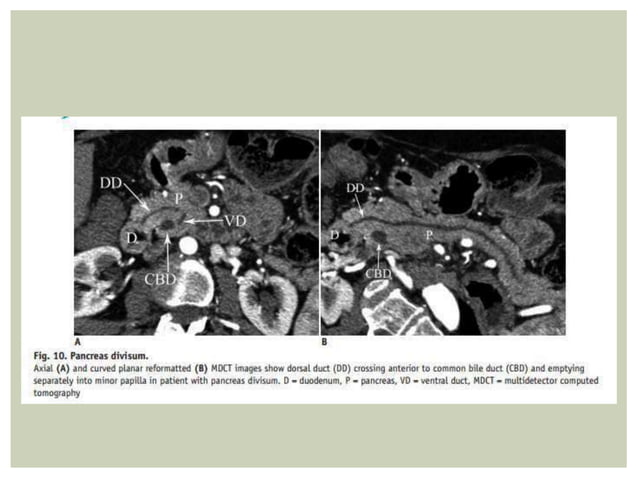 Normal pancreatic anatomy and anatomical variations | PPT