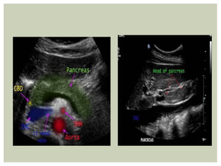 Normal pancreatic anatomy and anatomical variations | PPT