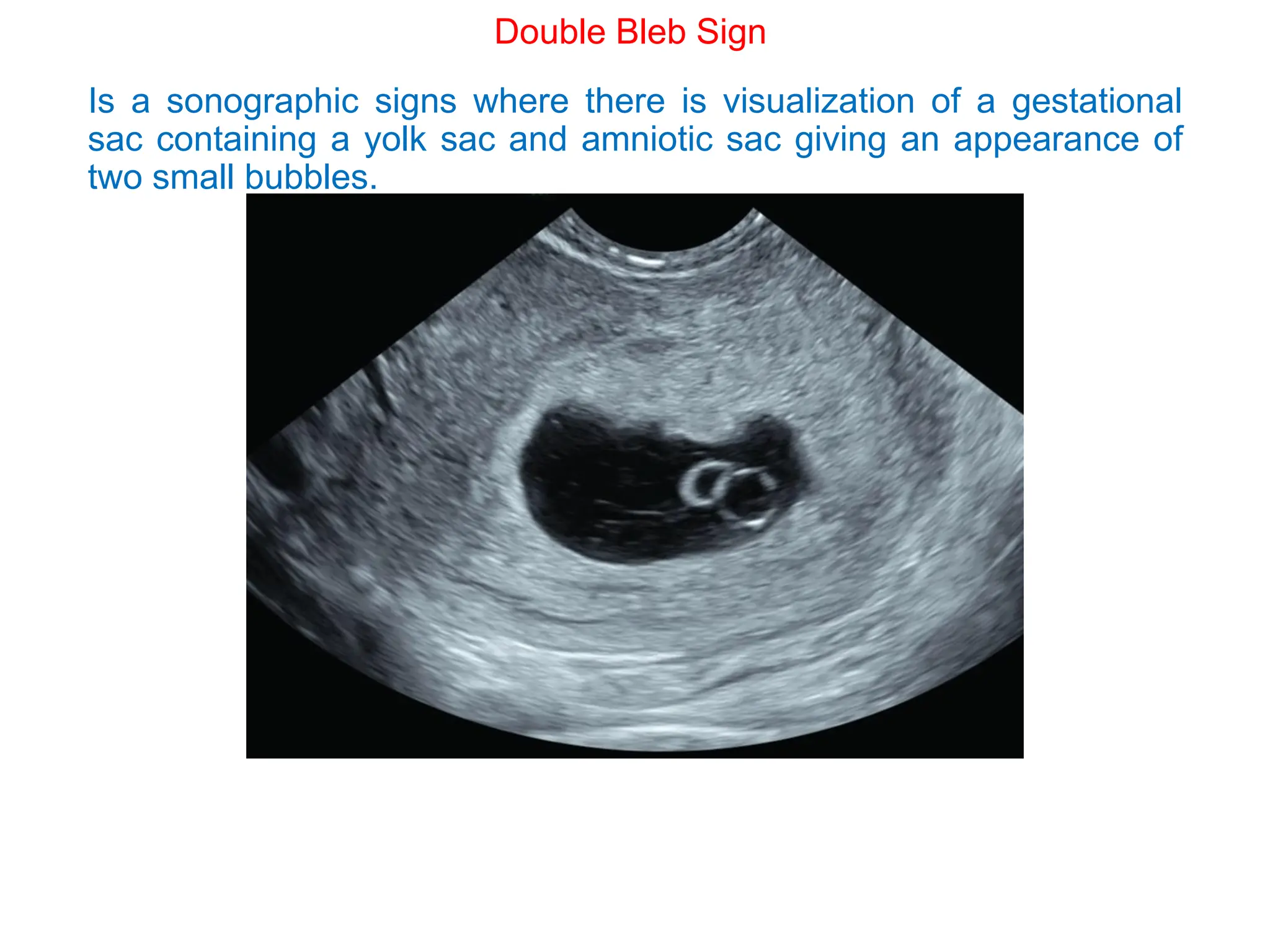 Normal Pregnancy Ultrasound- signs of yearly pregnancy , 2 and 3 ...