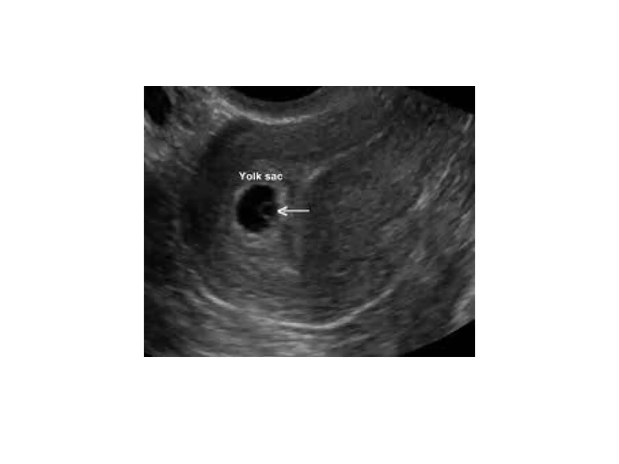 Normal Pregnancy Ultrasound- signs of yearly pregnancy , 2 and 3 ...