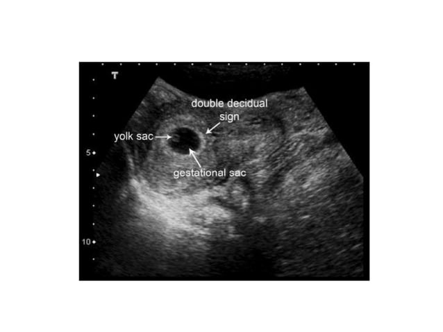 Normal Pregnancy Ultrasound- signs of yearly pregnancy , 2 and 3 ...