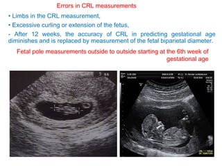 Normal Pregnancy Ultrasound- signs of yearly pregnancy , 2 and 3 ...