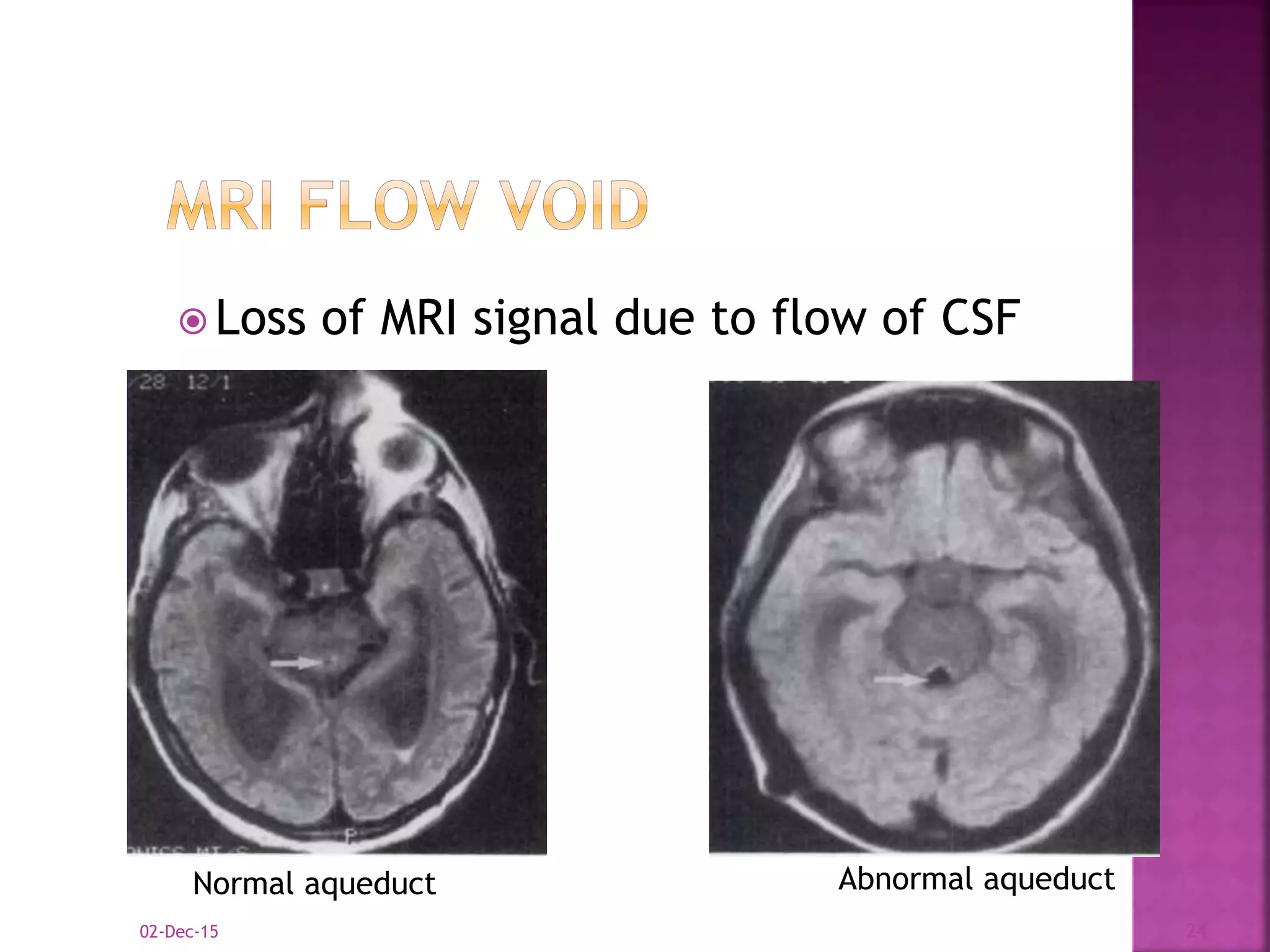 Normal pressure hydrocephalus | PPTX