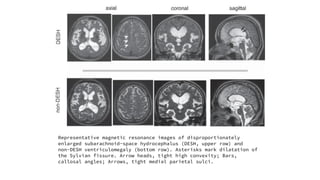 Normal pressure hydrocephalus presentation | PDF