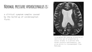 Normal pressure hydrocephalus presentation | PDF