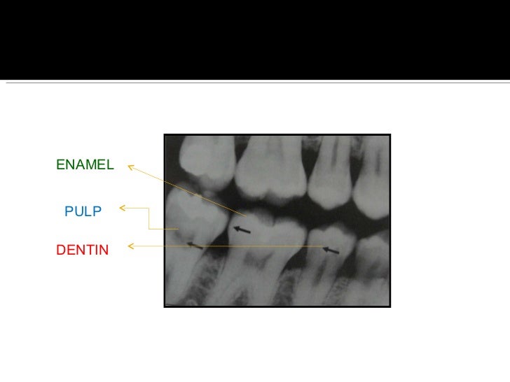 Normal Dental Radiographic Anatomy at Mitchell Dorgan blog