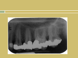 Normal oral radiographic anatomy | PPT