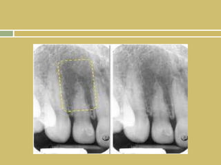 Normal oral radiographic anatomy | PPT