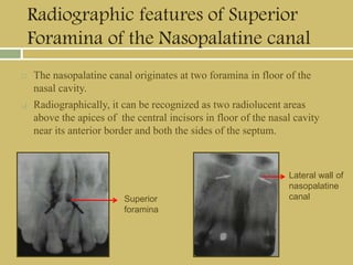 Nasopalatine Canal Radiograph