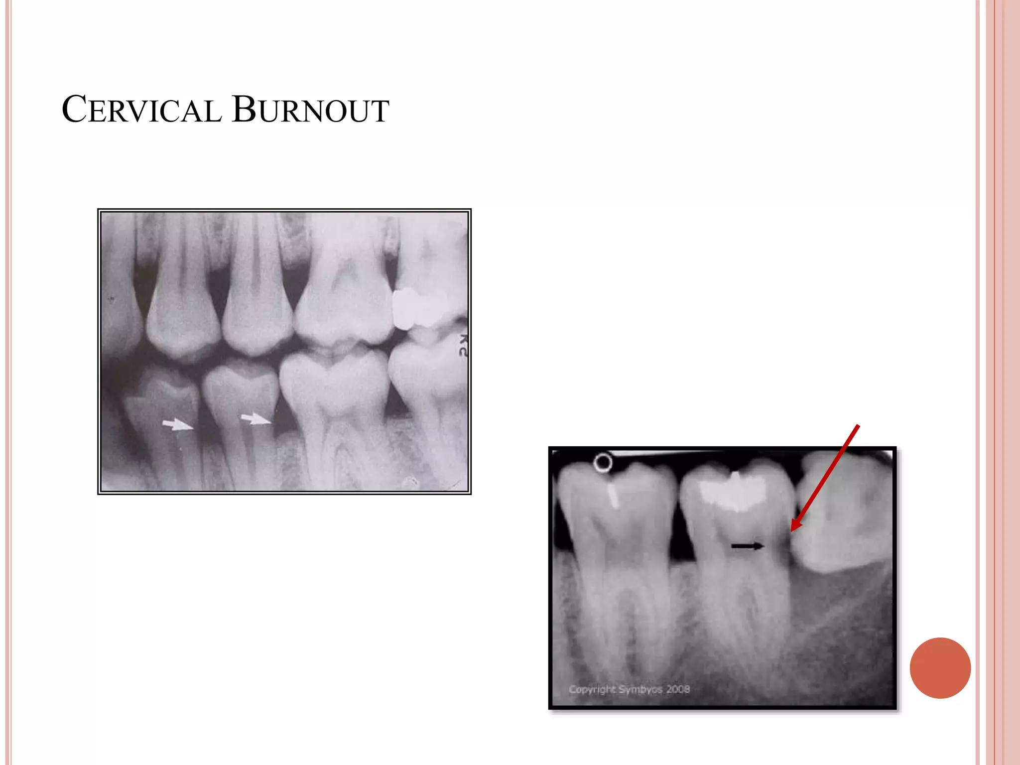 Normal radiographic anatomy | PPTX