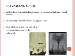 Normal radiographic anatomy | PPTX