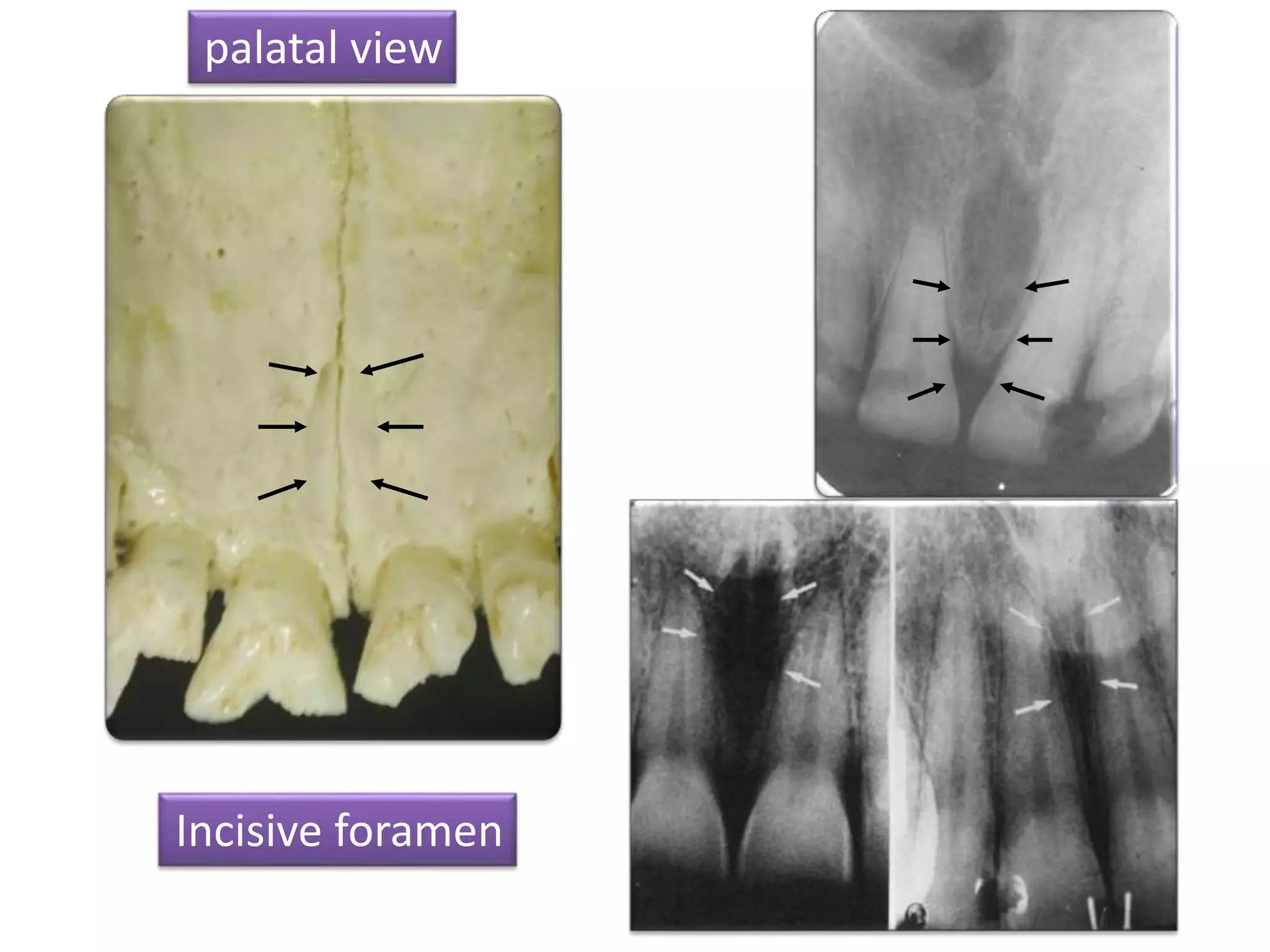 Normal radiographic anatomy .pptx