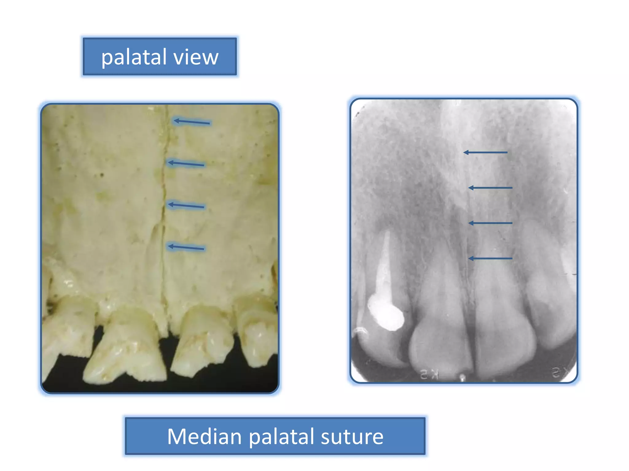 Normal radiographic anatomy .pptx