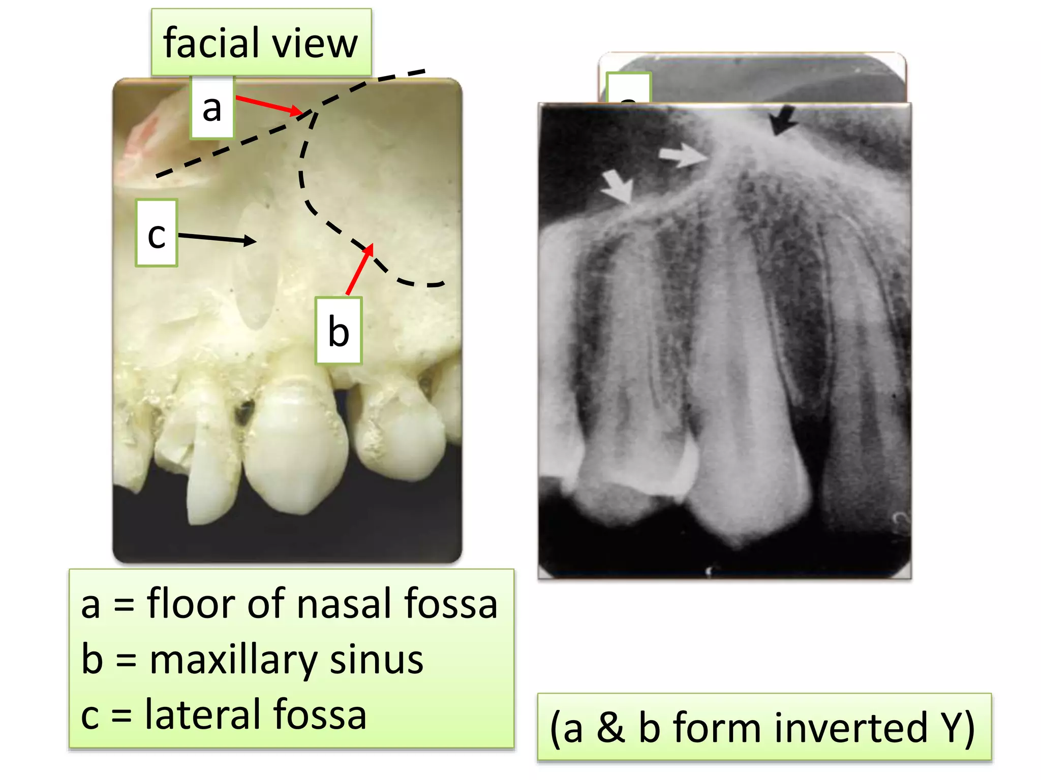 Normal radiographic anatomy .pptx