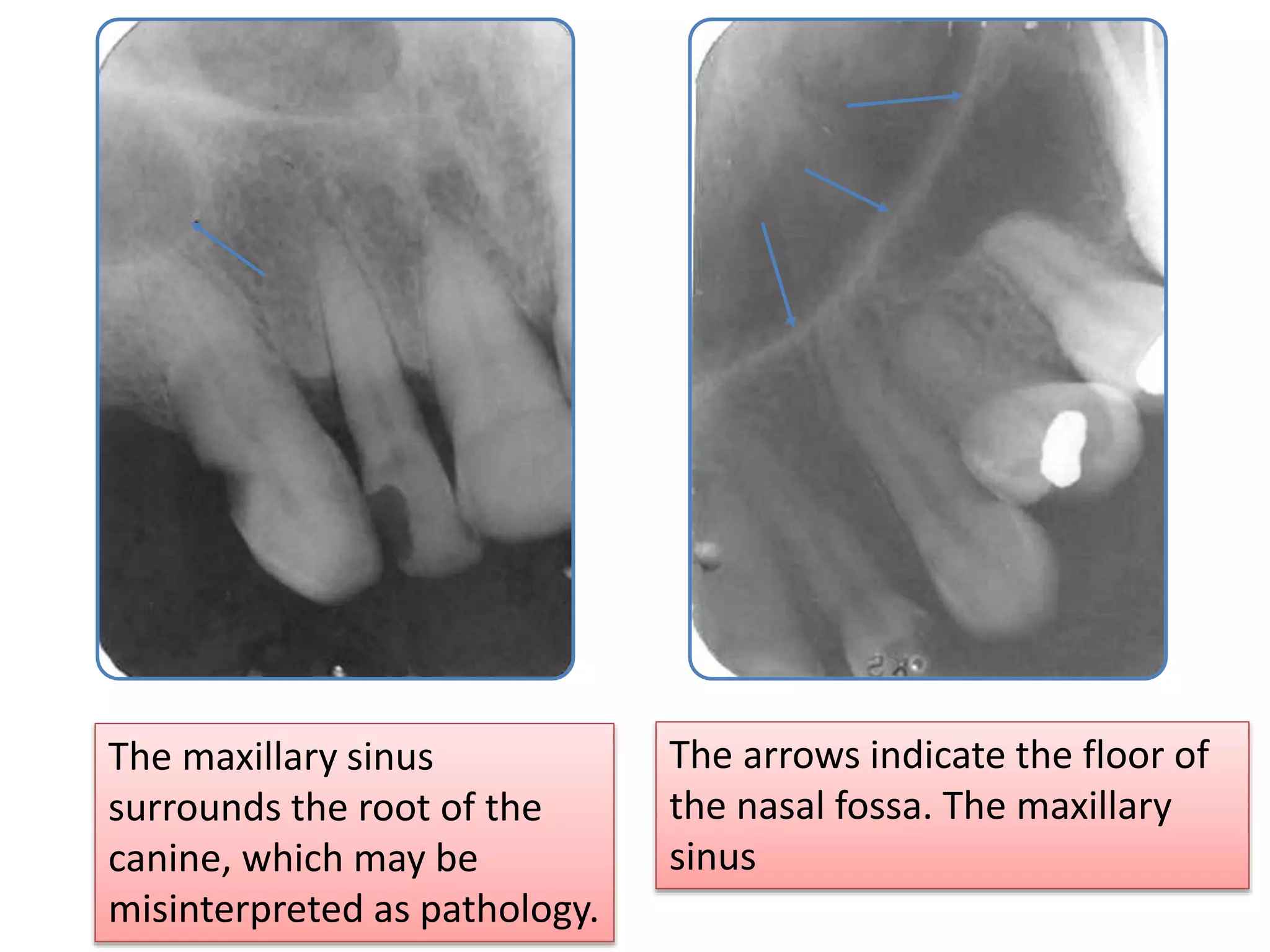 Normal radiographic anatomy .pptx