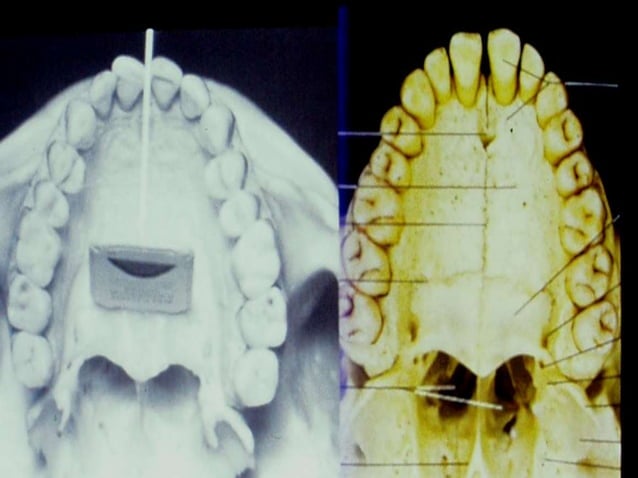 Normal radiographic anatomy .pptx