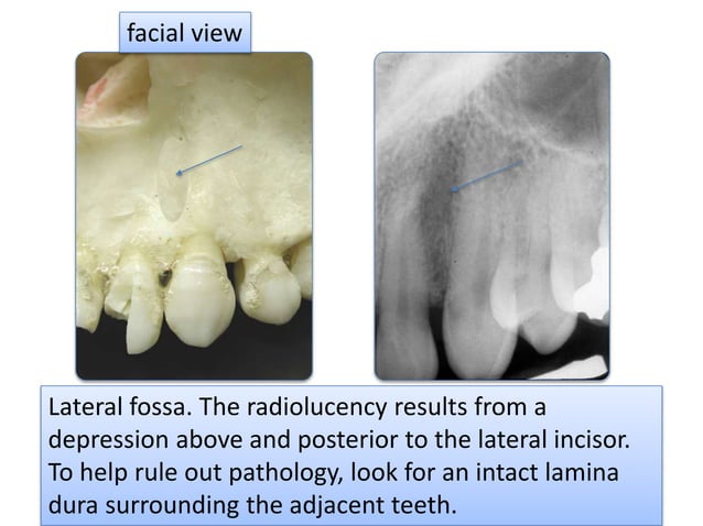 Normal radiographic anatomy .pptx
