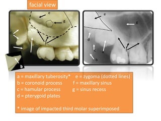 Normal radiographic anatomy .pptx