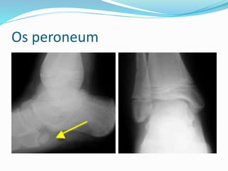 Normal radiographic variants of immature skeleton | PPTX