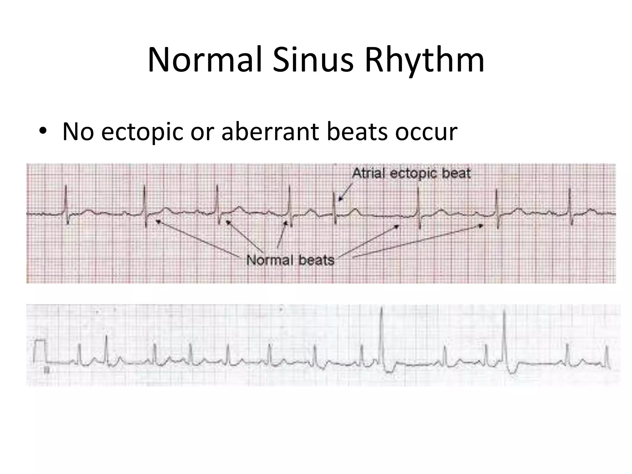 Normal sinus rhythm | PPTX | Heart and Cardiovascular Diseases ...