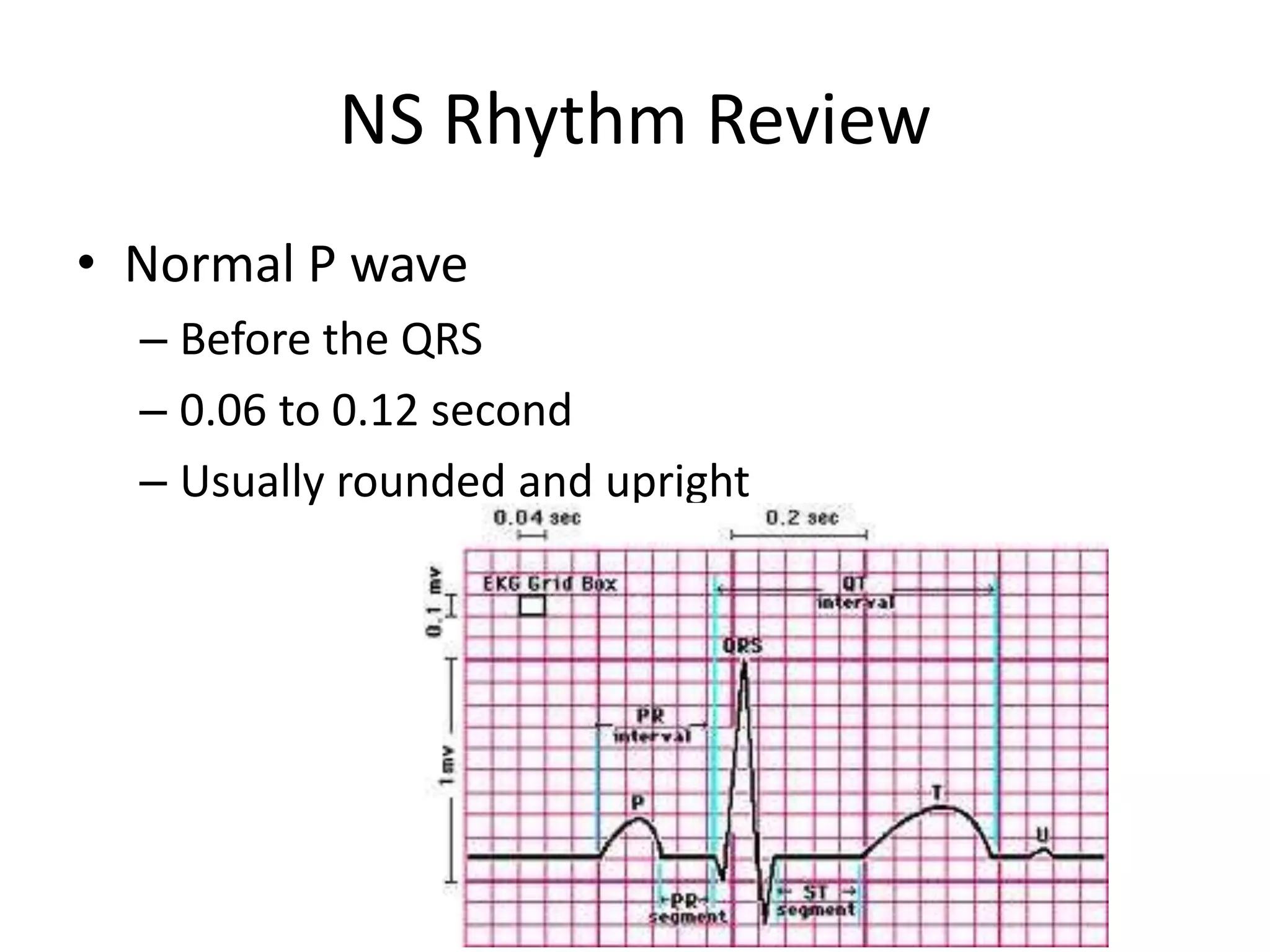 Normal sinus rhythm | PPTX