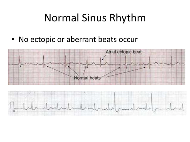 Normal sinus rhythm | PPTX | Heart and Cardiovascular Diseases ...