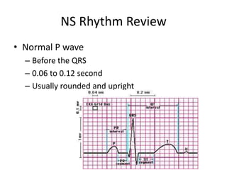 Normal sinus rhythm | PPTX