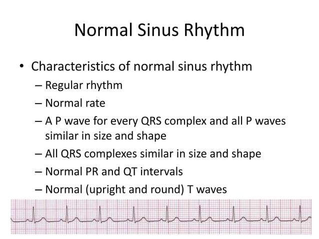Normal sinus rhythm | PPT