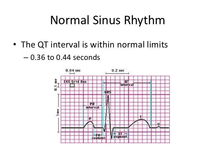 Normal sinus rhythm