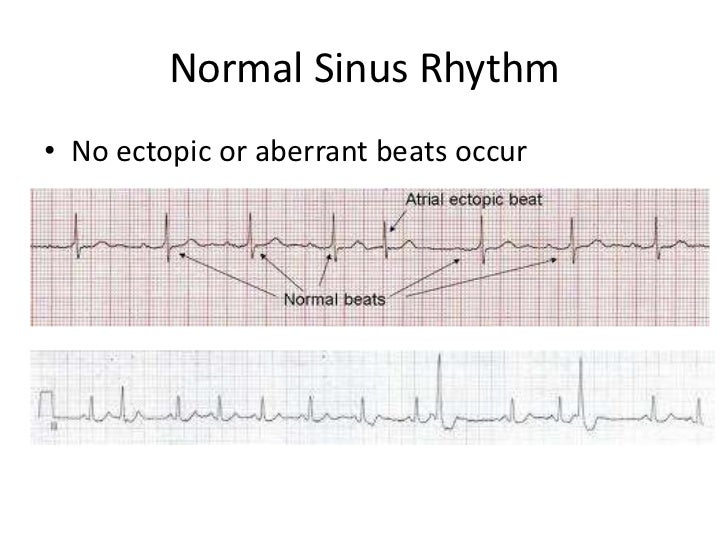 Normal sinus rhythm