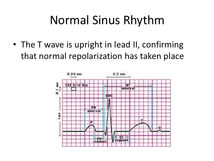 Normal sinus rhythm
