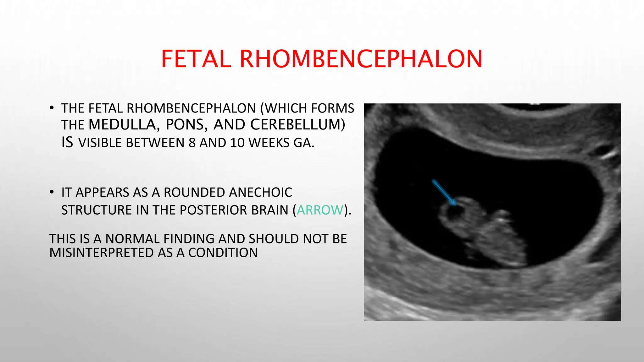 NORMAL SONOLOGICAL FINDING IN FRIST TRIMESTER.pptx