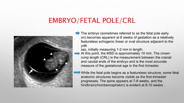 NORMAL SONOLOGICAL FINDING IN FRIST TRIMESTER.pptx
