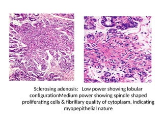NORMAL STRUCTURE OF BREAST AND BENIGN LESIONS OF (2).pptx