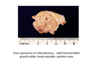 NORMAL STRUCTURE OF BREAST AND BENIGN LESIONS OF (2).pptx