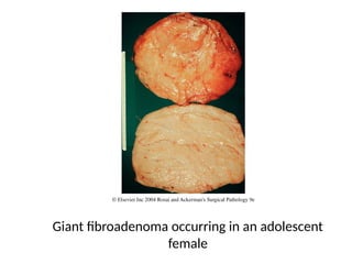 NORMAL STRUCTURE OF BREAST AND BENIGN LESIONS OF (2).pptx