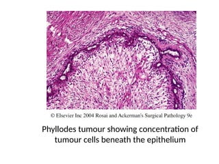 NORMAL STRUCTURE OF BREAST AND BENIGN LESIONS OF (2).pptx