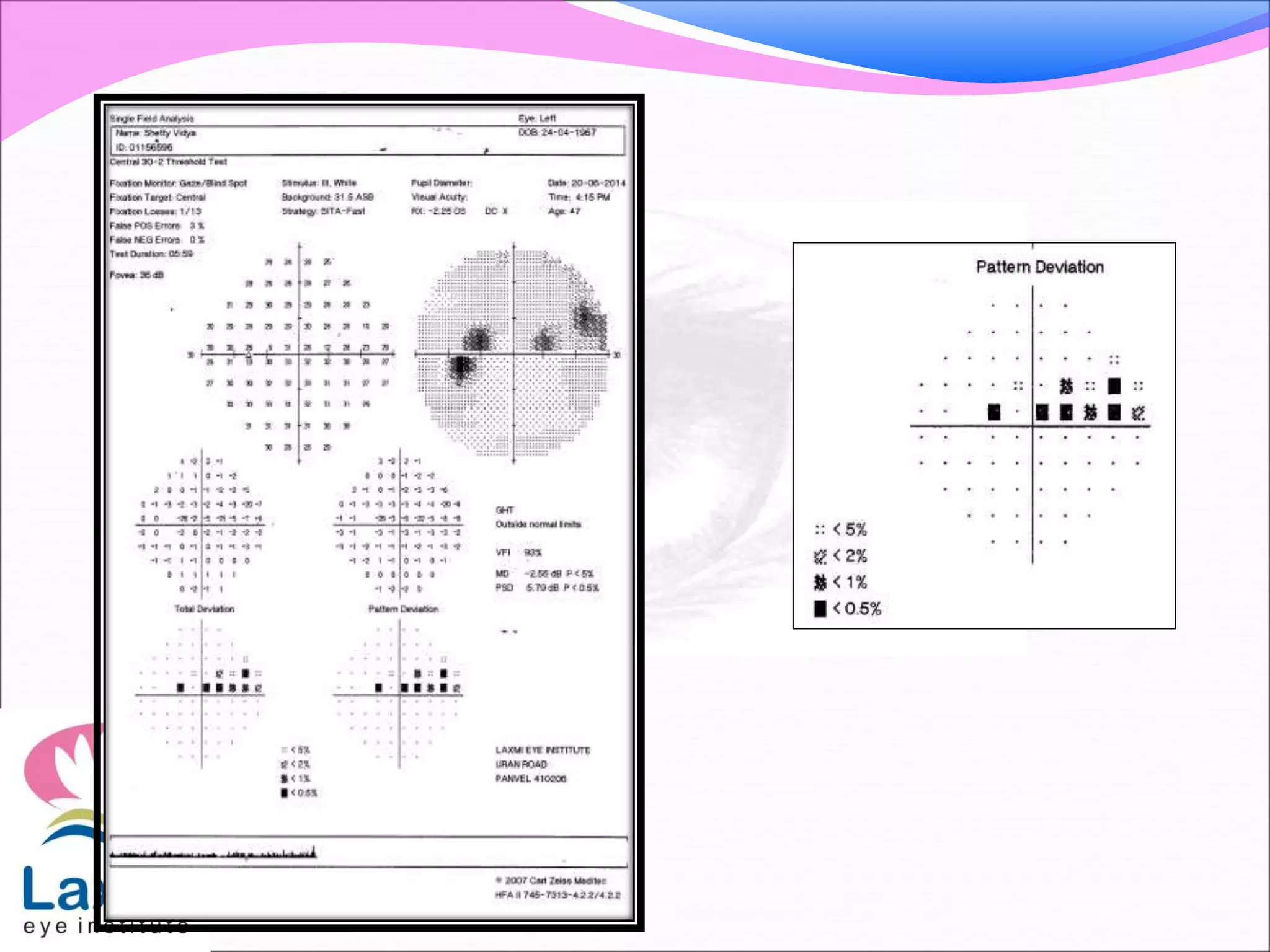 Normal tension glaucoma | PPTX